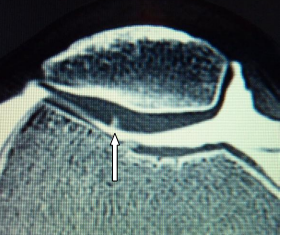 GENOU - Pathologies rotuliennes | Docteur Franck Schaison - Chirurgien ...